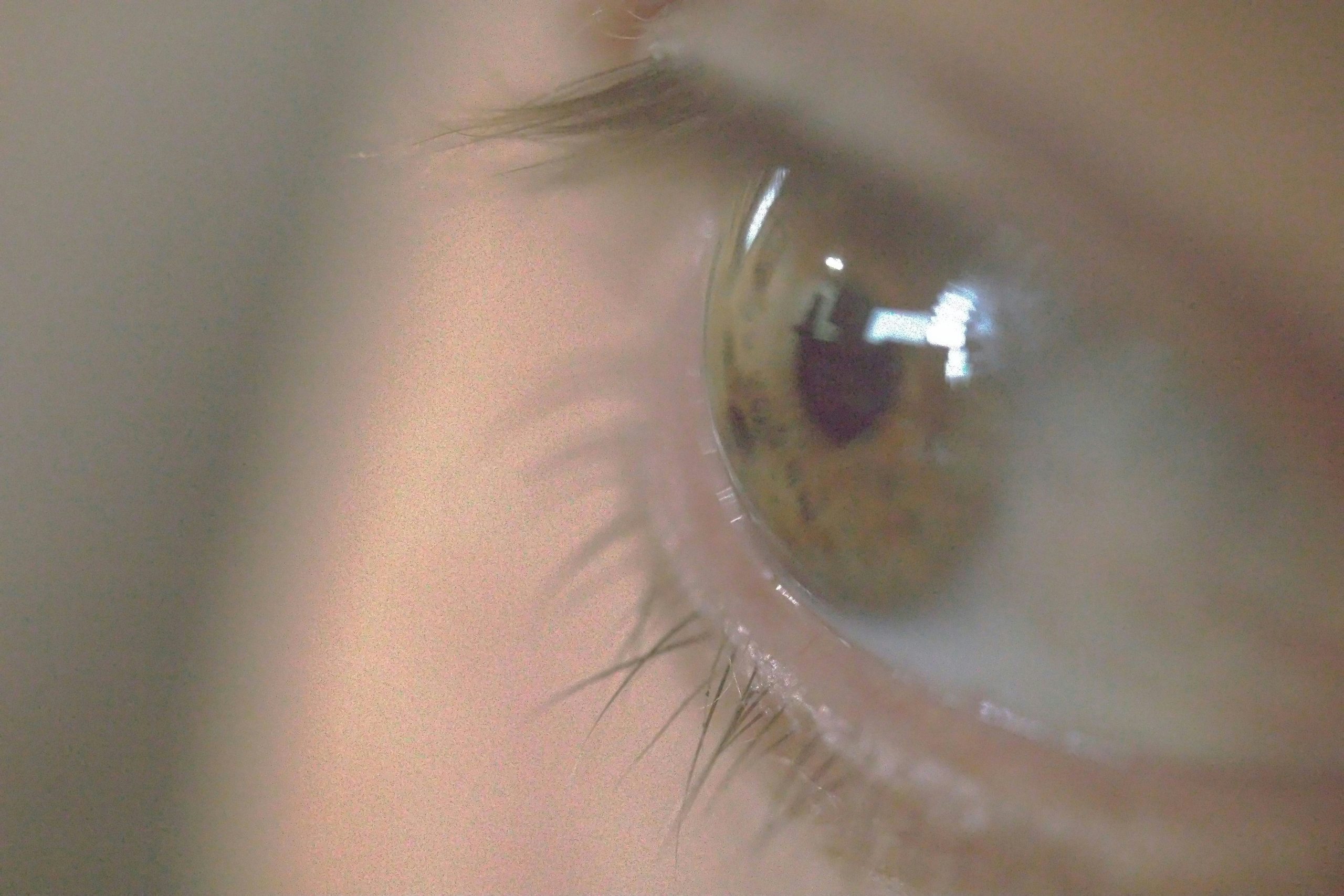 How to Apply Eye Drops Correctly | Step-by-Step Guide